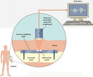 Monitoring Broken Bones Without Using Electronics: Wireless Bone Monitor